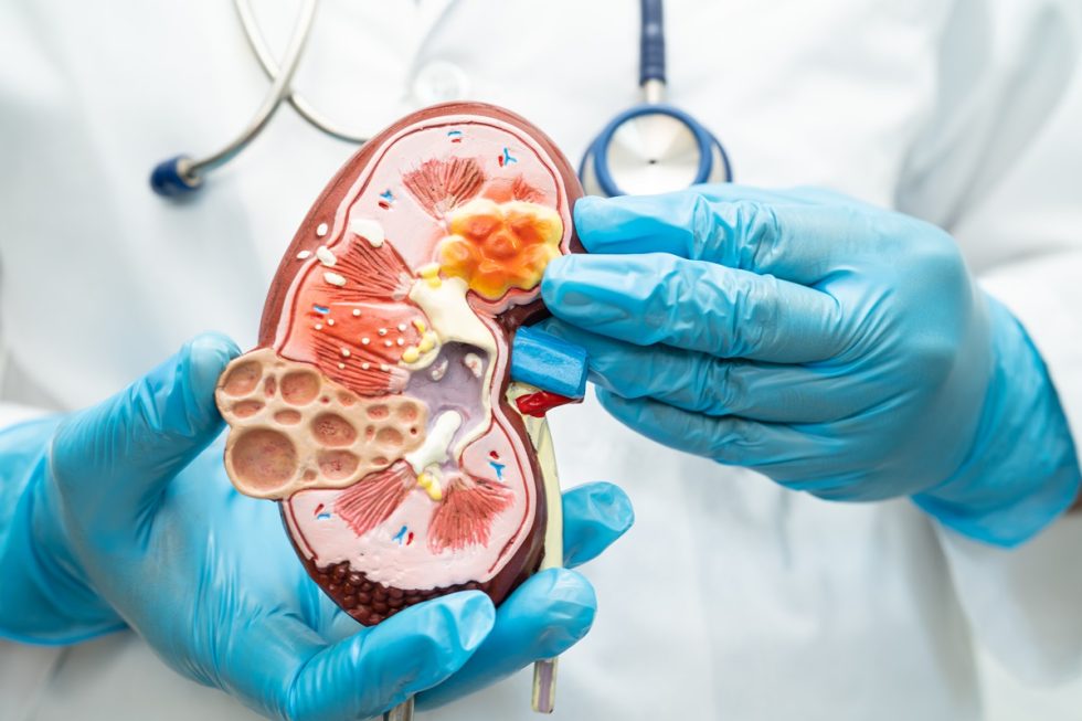 Toledo Nephrolithiasis (Kidney Stones) Doctor | Toledo Clinic Nephrology